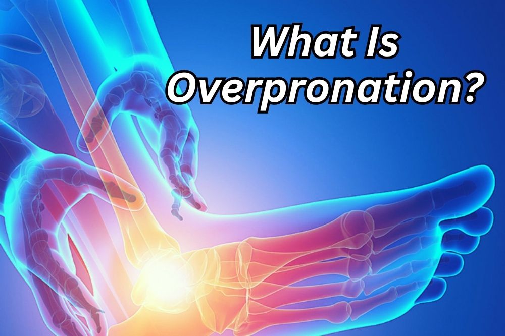 What Is Overpronation? Causes, Symptoms, Diagnosis, and Treatment ...